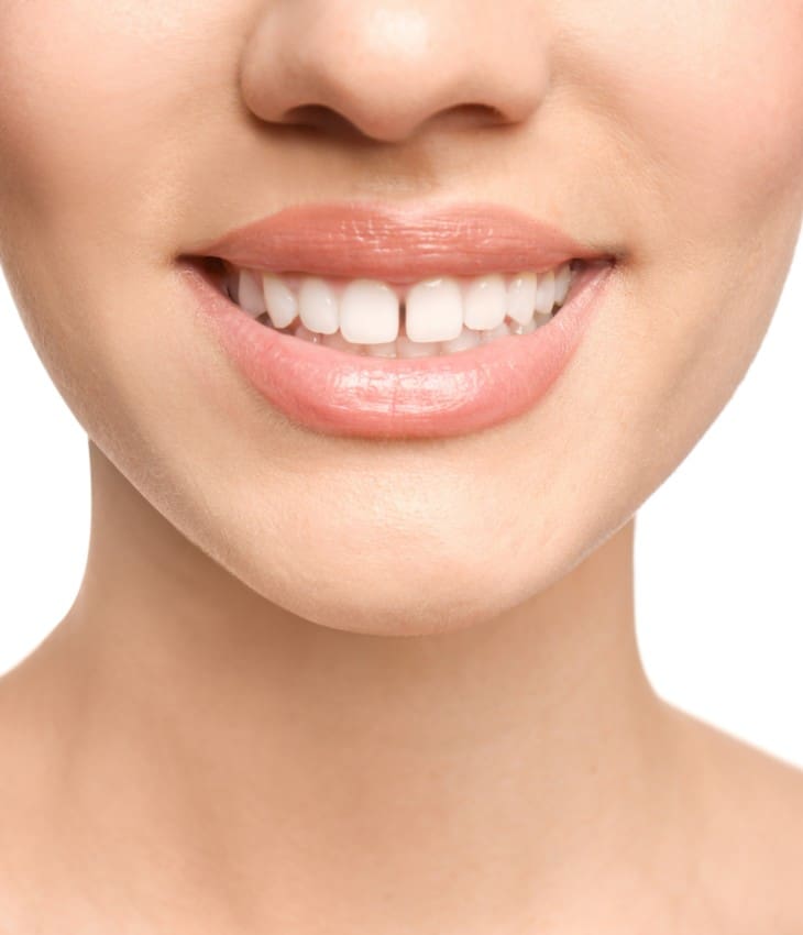 Spaced Teeth - New Ash Green Dental & Aesthetics